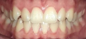 INVISALIGN Dubai | Clear Aligners | Invisible Braces in Dubai